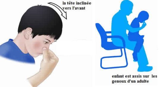 Saignements : cas particuliers [Les saignements : le garrot et les cas ...